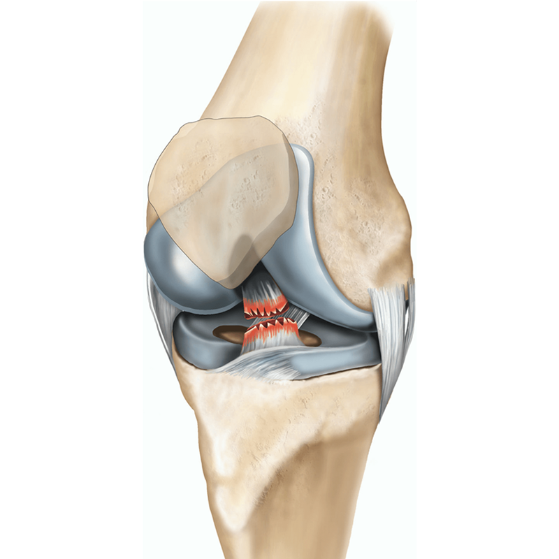 News - Simple ACL Reconstruction Instrument Set