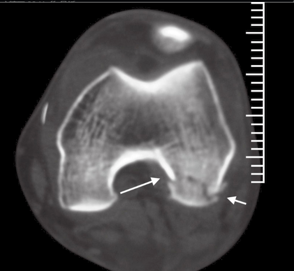 News - Causes and treatment of Hoffa fracture